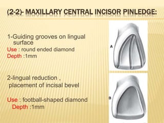 The partial veneer crown , inlay and onlay.pptx