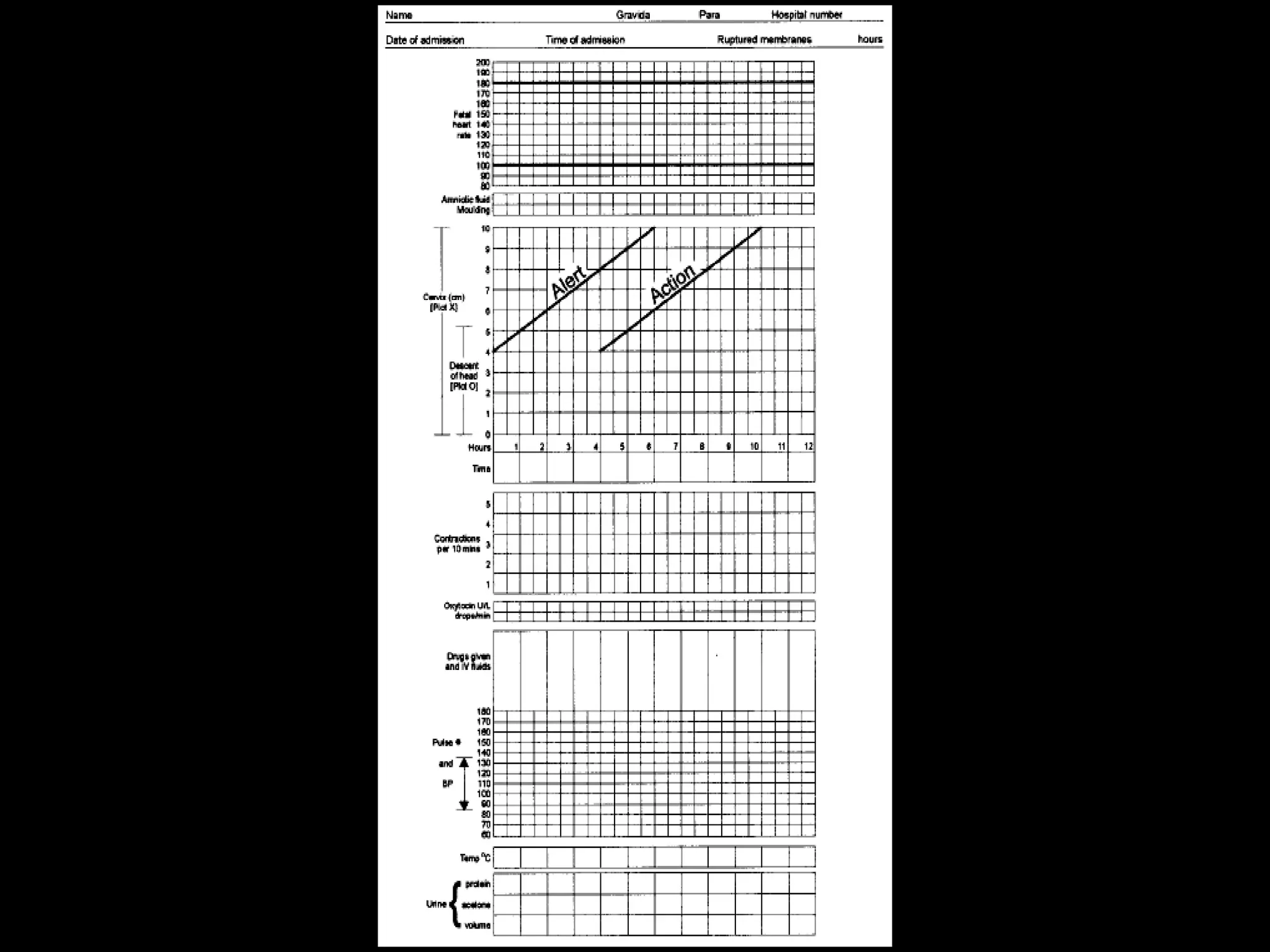 The partograph case tz | PPT
