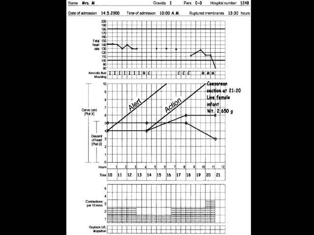 The partograph case tz | PPT | Free Download