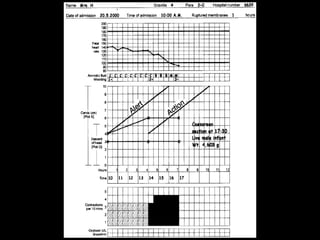 The partograph case tz | PPT