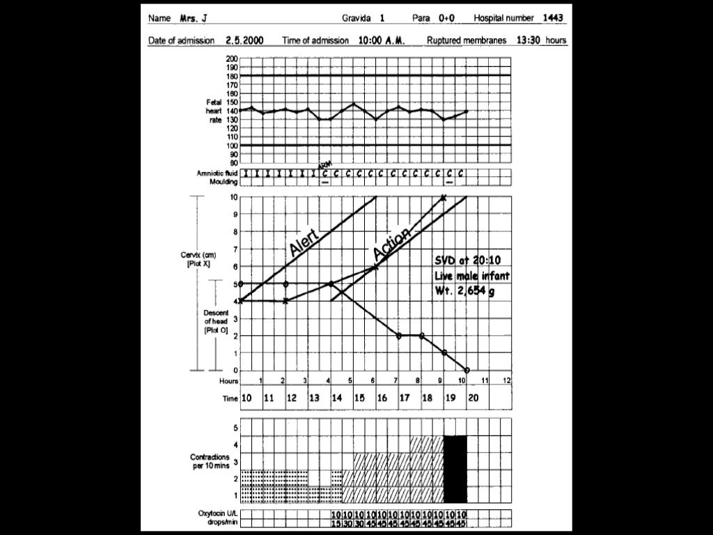 The partograph case tz