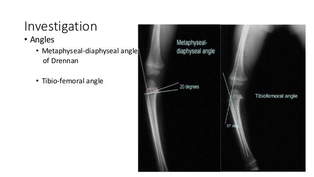 The pathology and management of blount’s disease