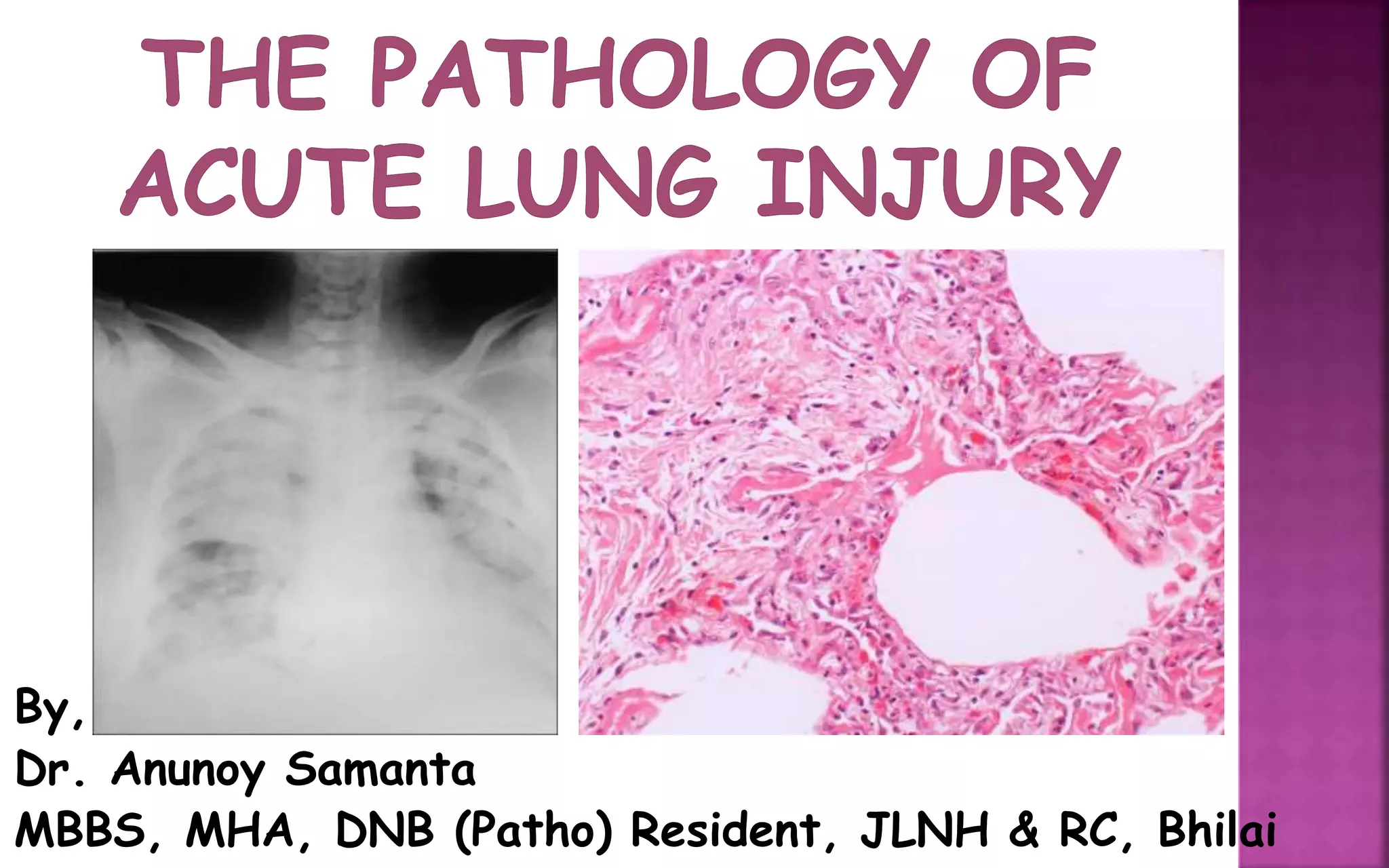 The Pathology of Acute Lung Injury | PPT