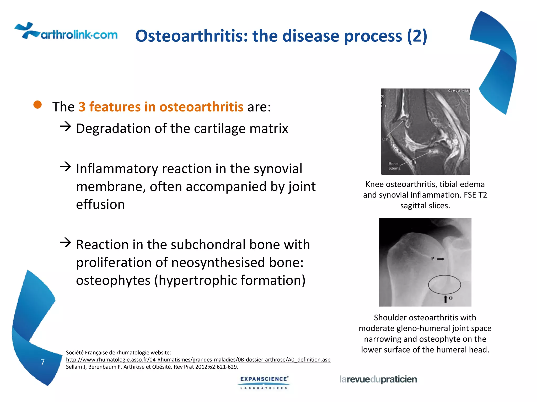The pathophysiology of osteoarthritis | PPT