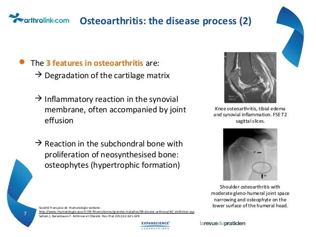 The Pathophysiology Of Osteoarthritis