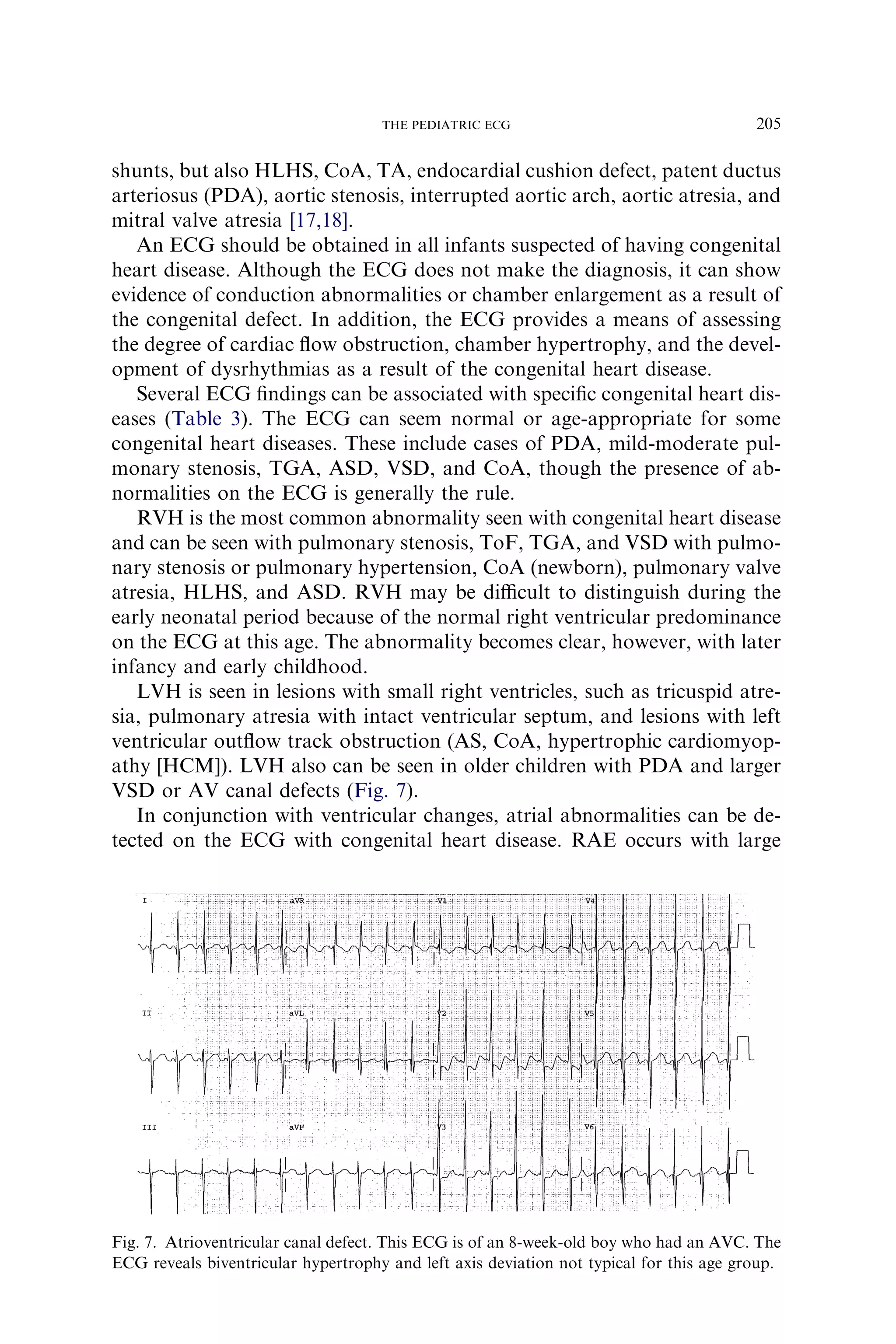 The pediatric ecg | PDF