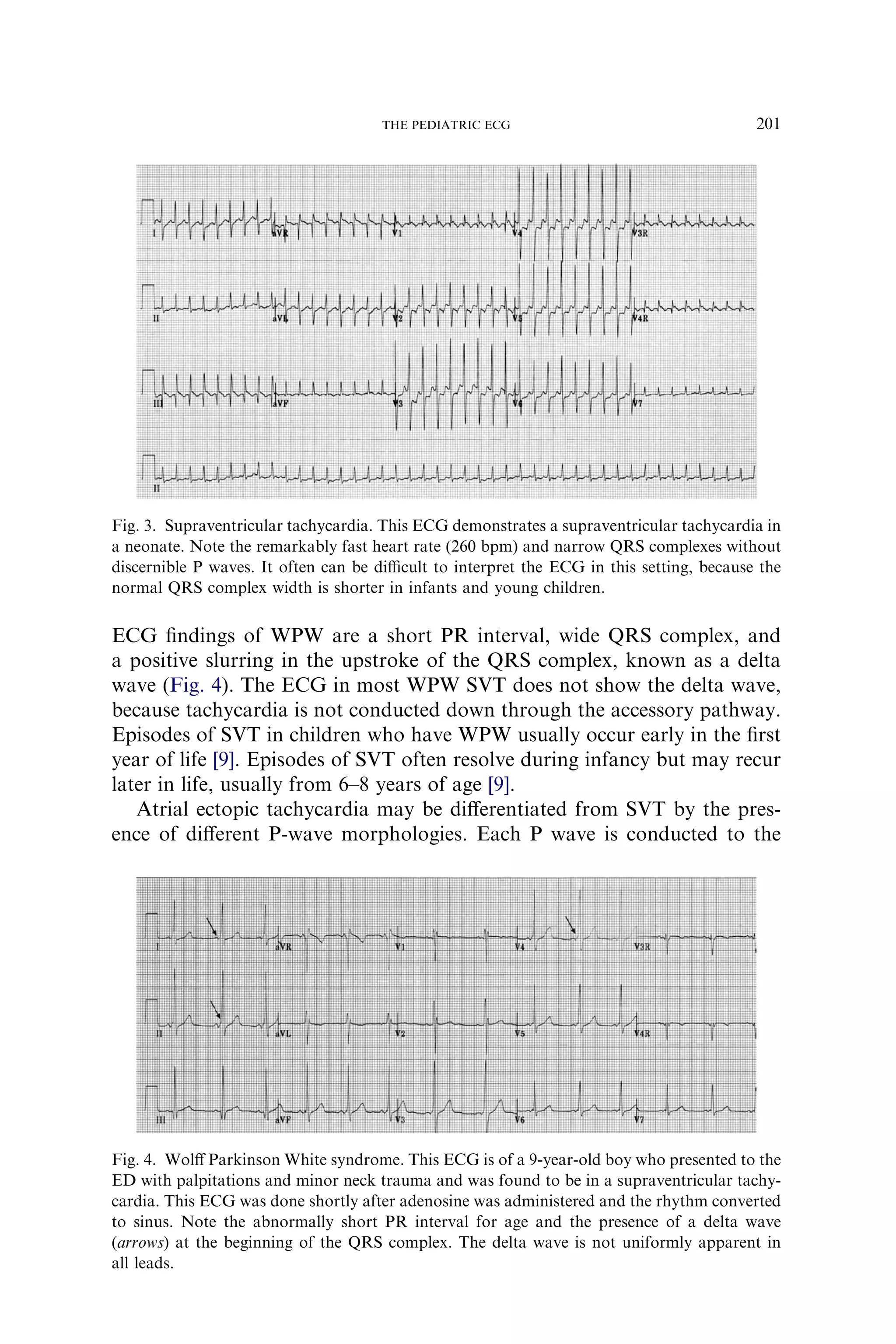 The pediatric ecg | PDF