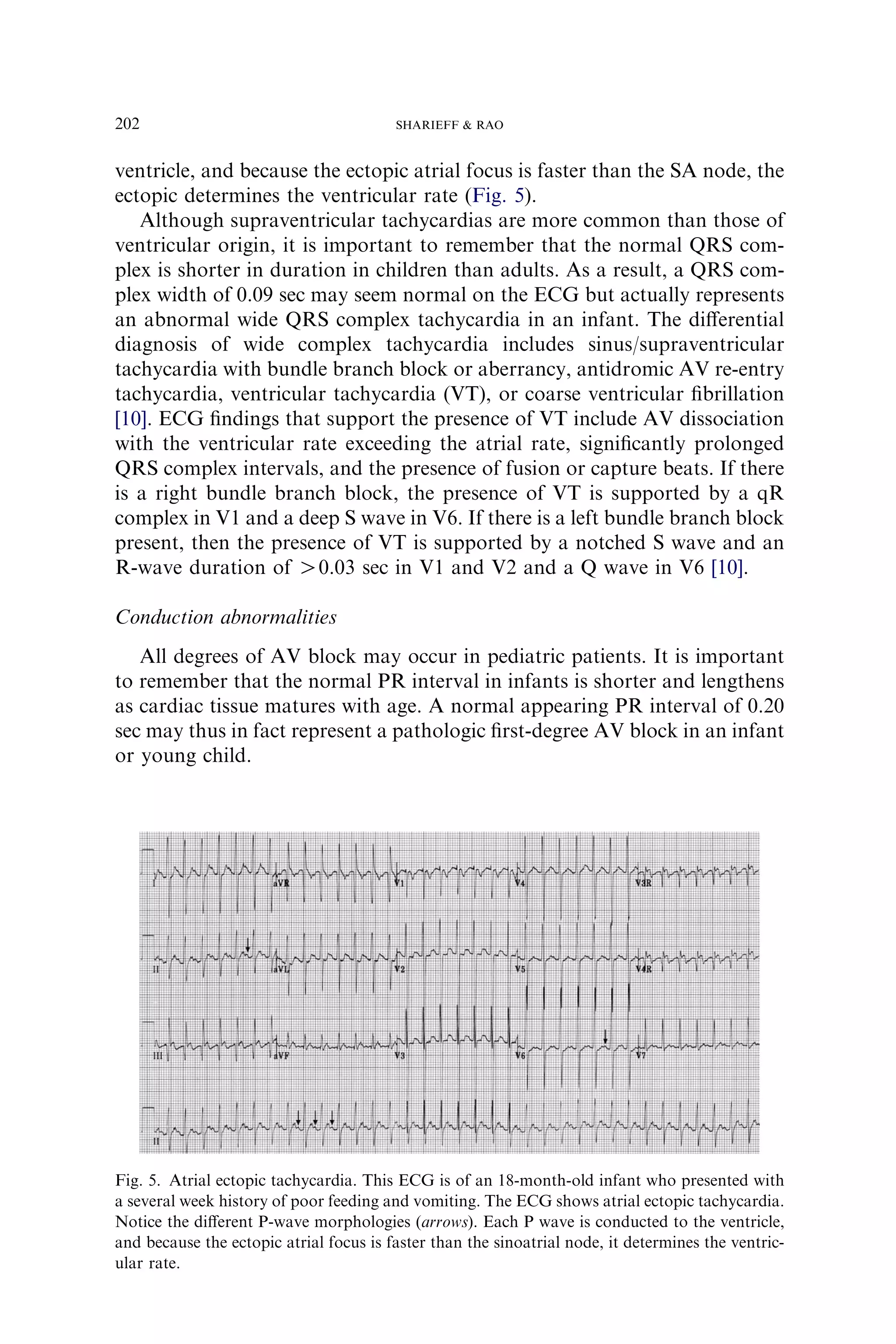 The pediatric ecg | PDF