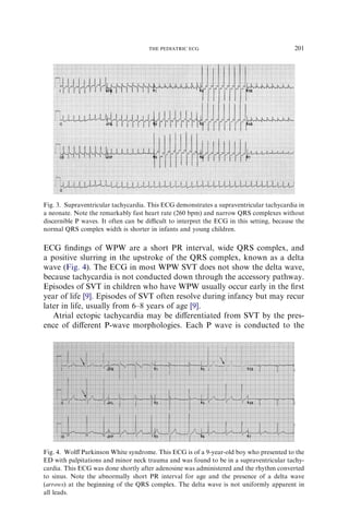 The pediatric ecg | PDF