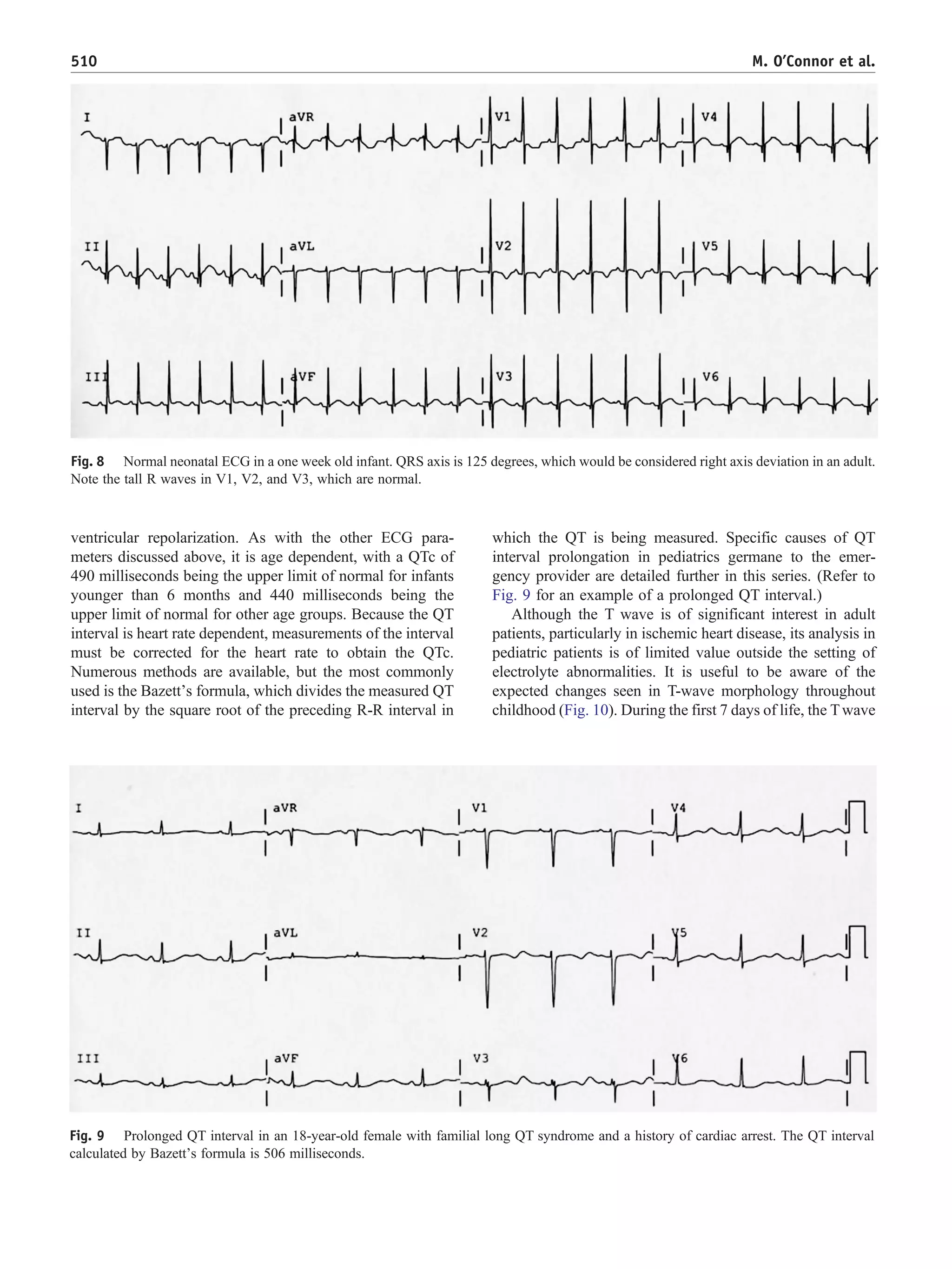 The pediatric electrocardiogram 1 | PDF