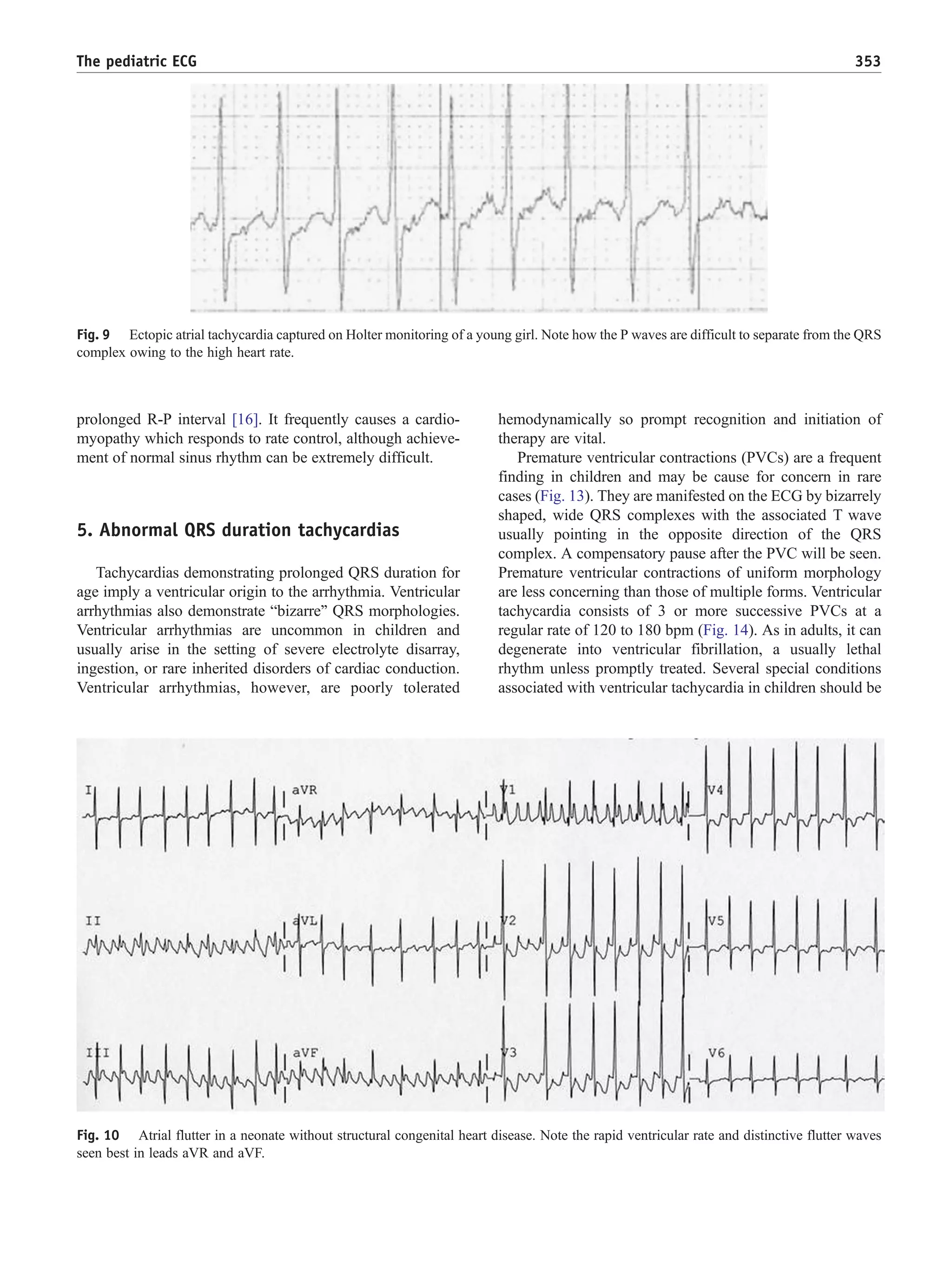 The pediatric electrocardiogram 2 | PDF