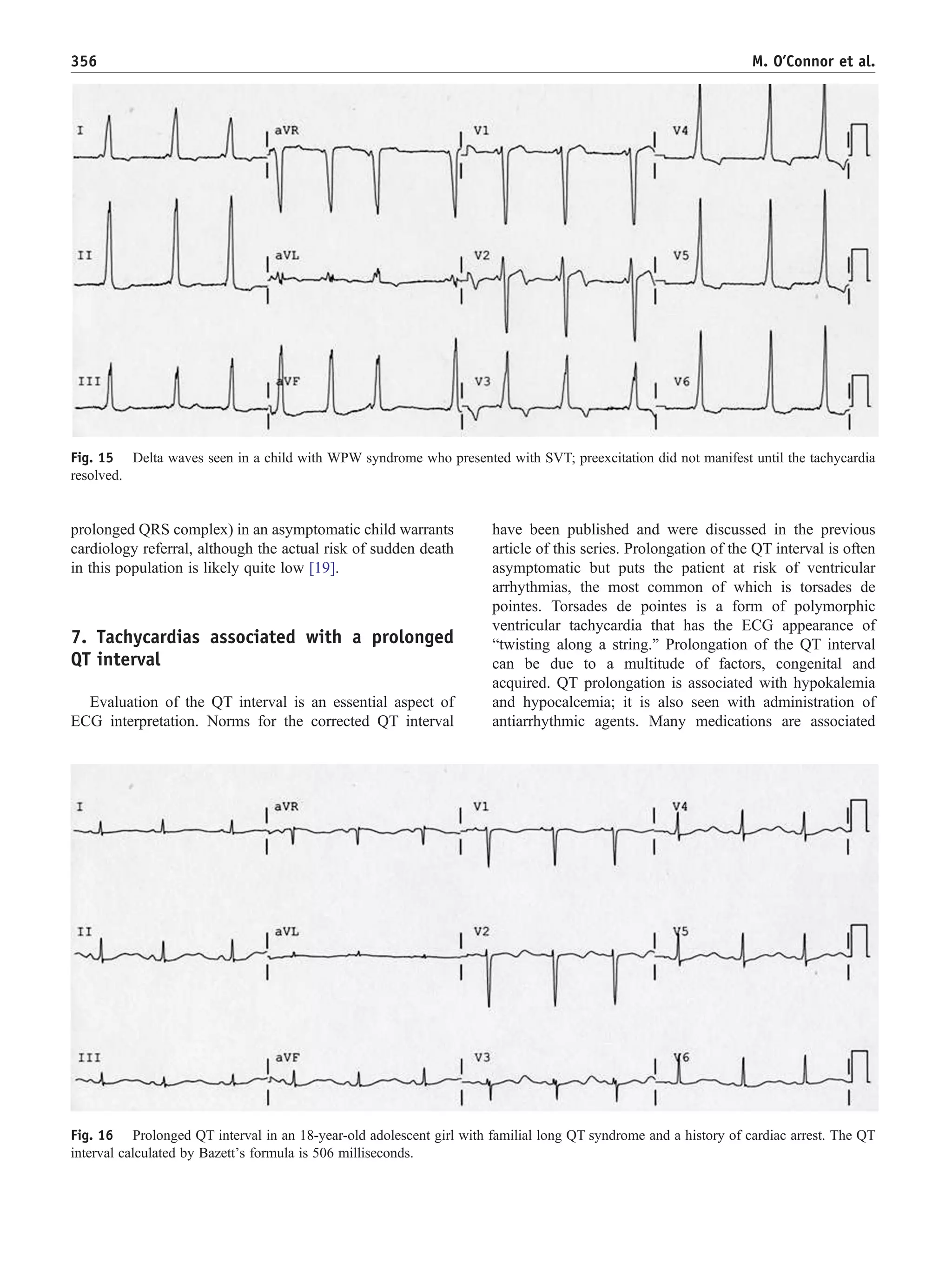 The pediatric electrocardiogram 2 | PDF