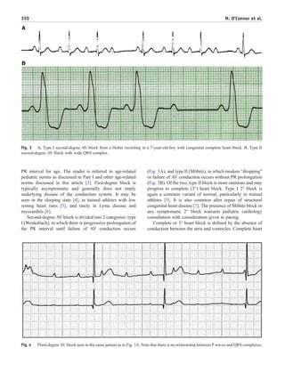 The pediatric electrocardiogram 2 | PDF