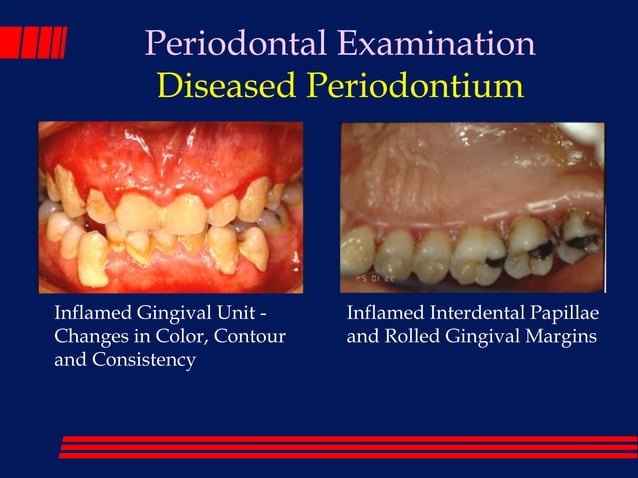 The periodontal examination_and_diagnosis_lec 1 | PDF