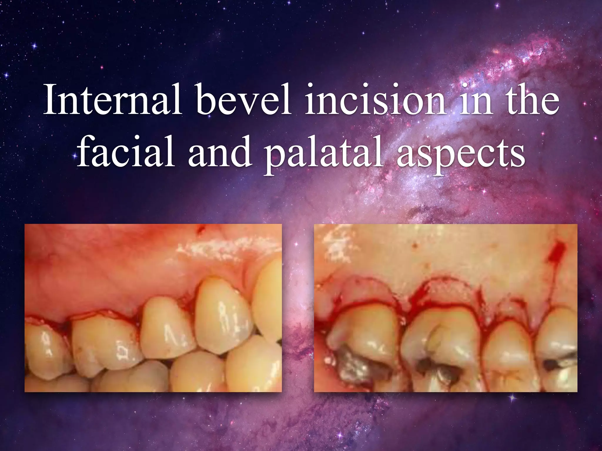 The periodontal flap | PDF