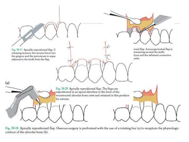 The periodontal flap | PPTX | Oral care | Personal Care