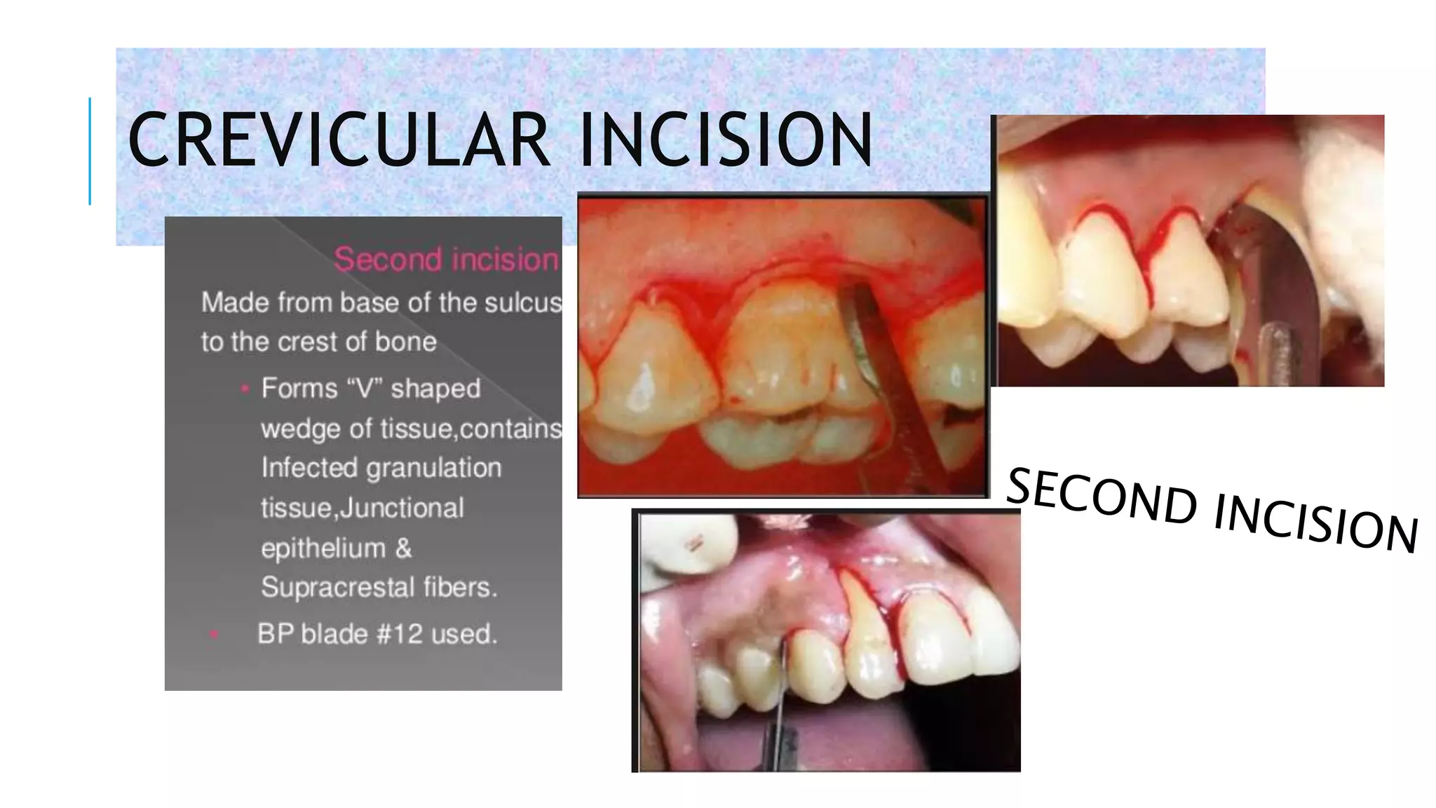 The periodontal flap | PPT