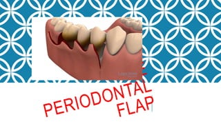 The periodontal flap | PPT