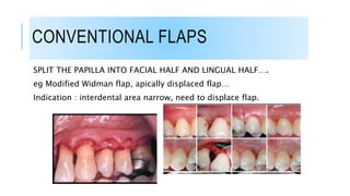 The periodontal flap | PPT
