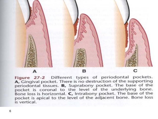 The periodontal pocket - lec 2