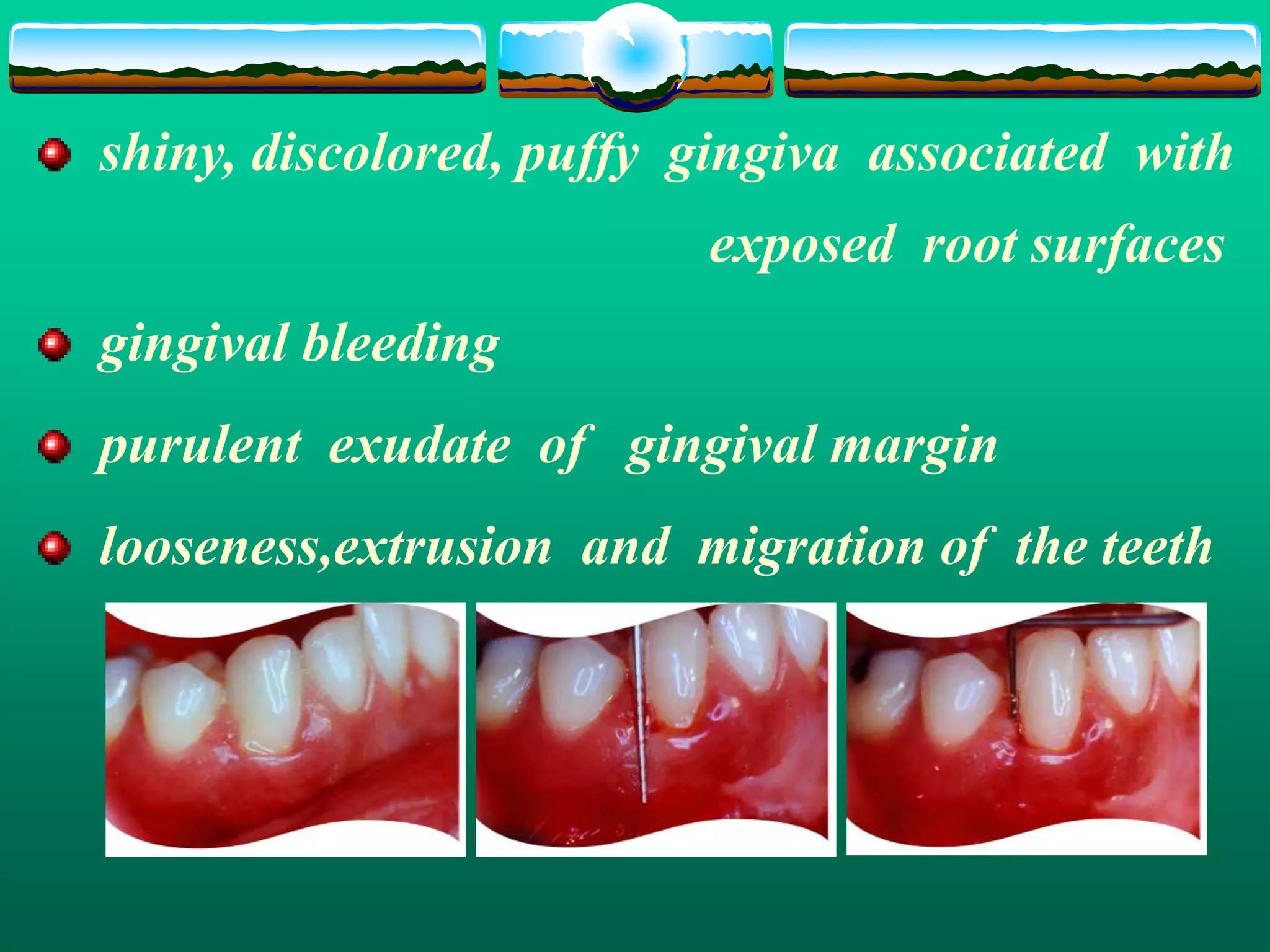 THE PERIODONTAL POCKET.ppt