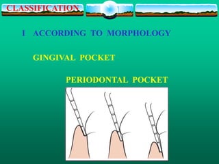 THE PERIODONTAL POCKET.ppt