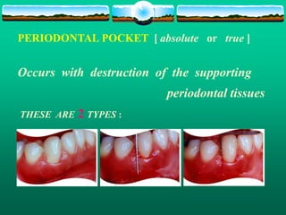 THE PERIODONTAL POCKET.ppt