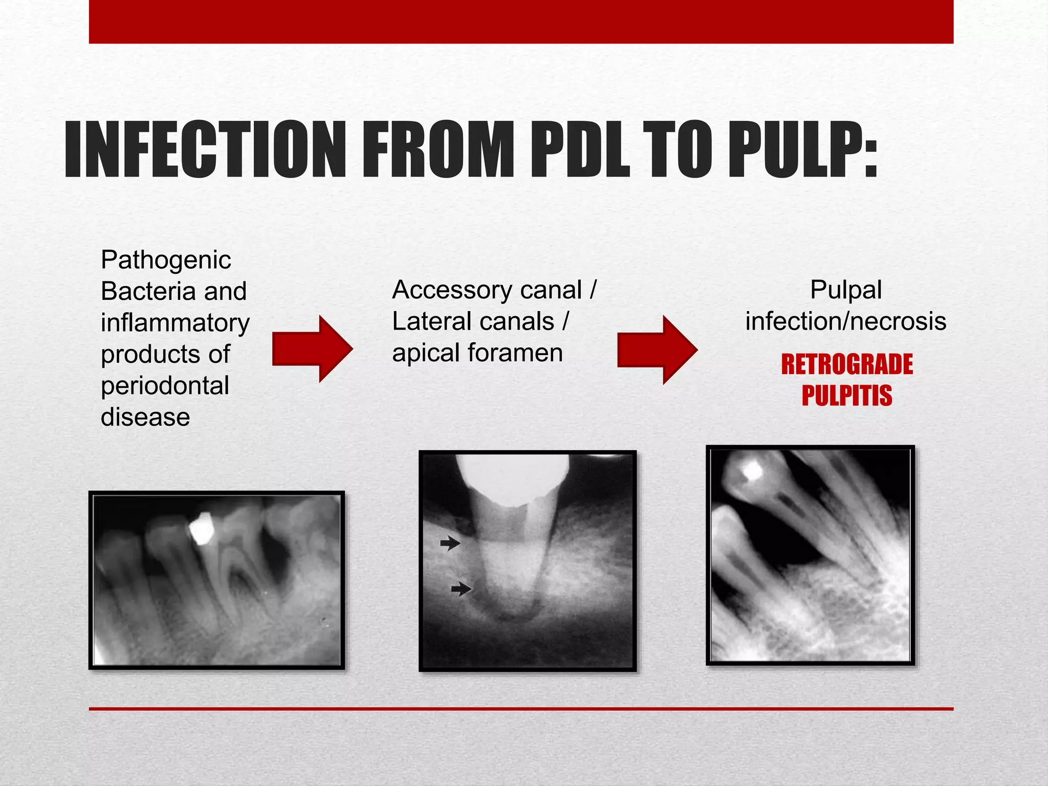 Perio Endo Inter-Relationship | PPTX