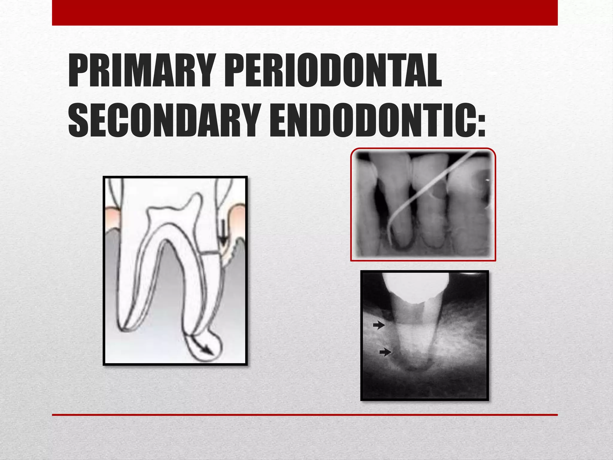 Perio Endo Inter-Relationship | PPTX