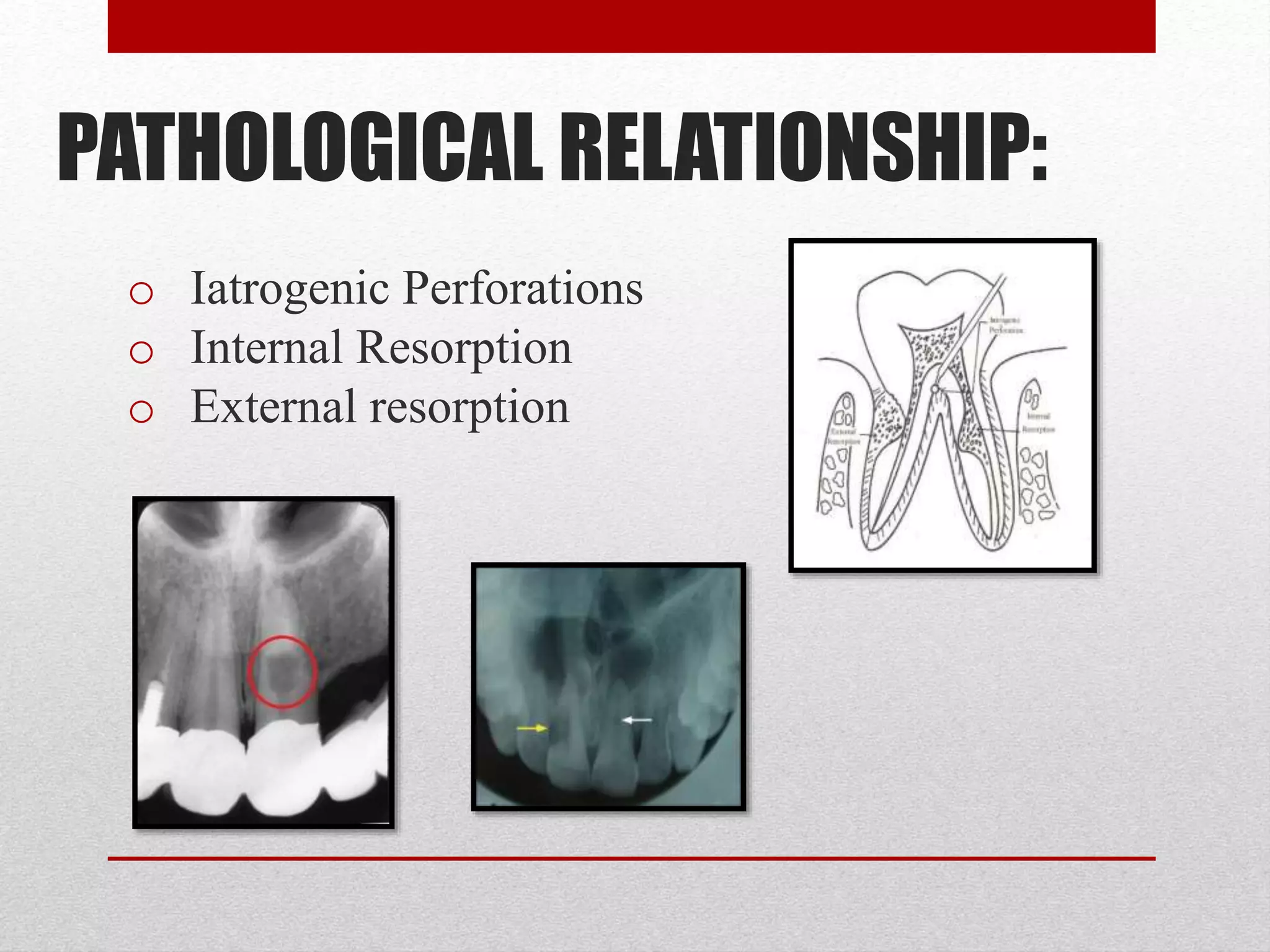 Perio Endo Inter-Relationship | PPTX