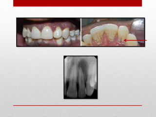 Perio Endo Inter-Relationship | PPTX