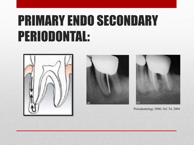 Perio Endo Inter-Relationship | PPTX
