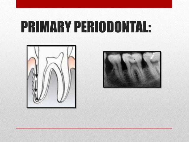 Perio Endo Inter-Relationship | PPTX