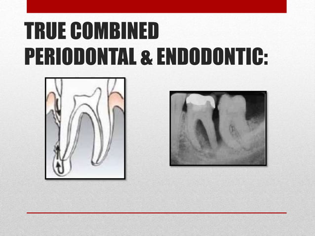 Perio Endo Inter-Relationship | PPTX