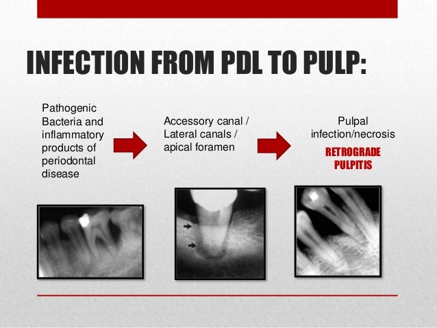 Perio Endo Inter-Relationship