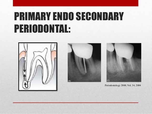 Perio Endo Inter-Relationship