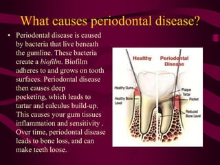 The Perio Protect Program | PPT