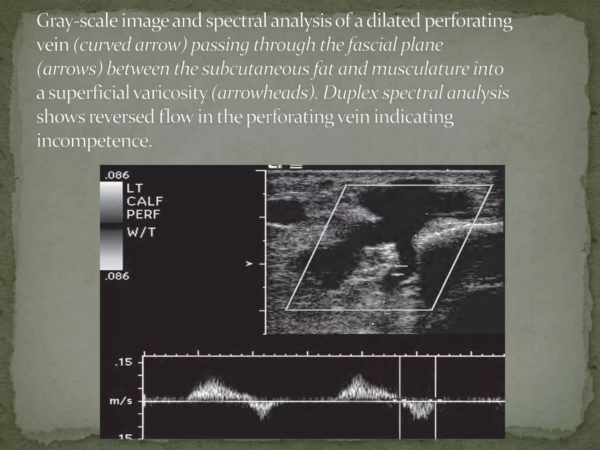 The peripheral veins | PPTX