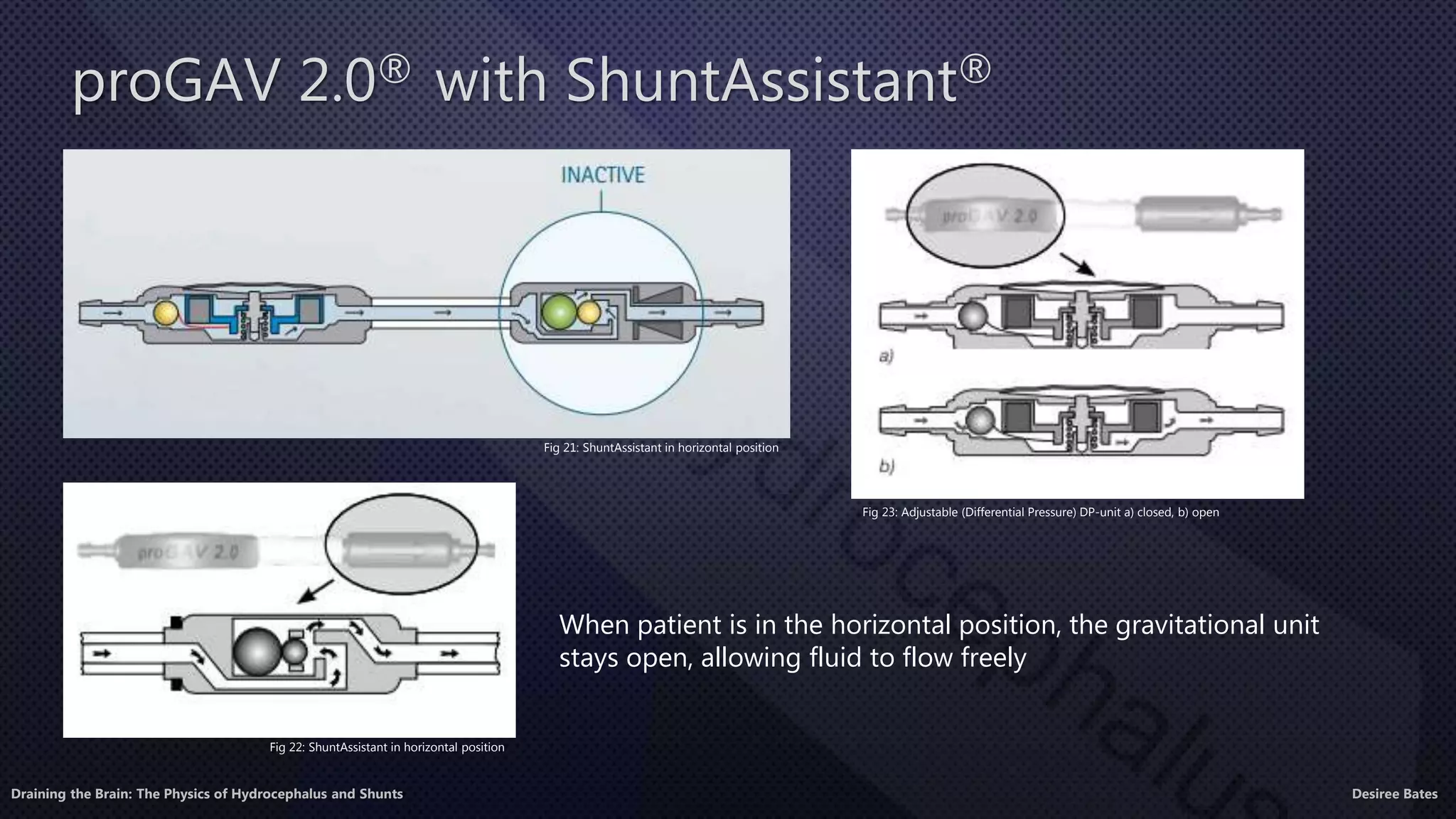 The Physics of Hydrocephalus and Shunts | PPTX