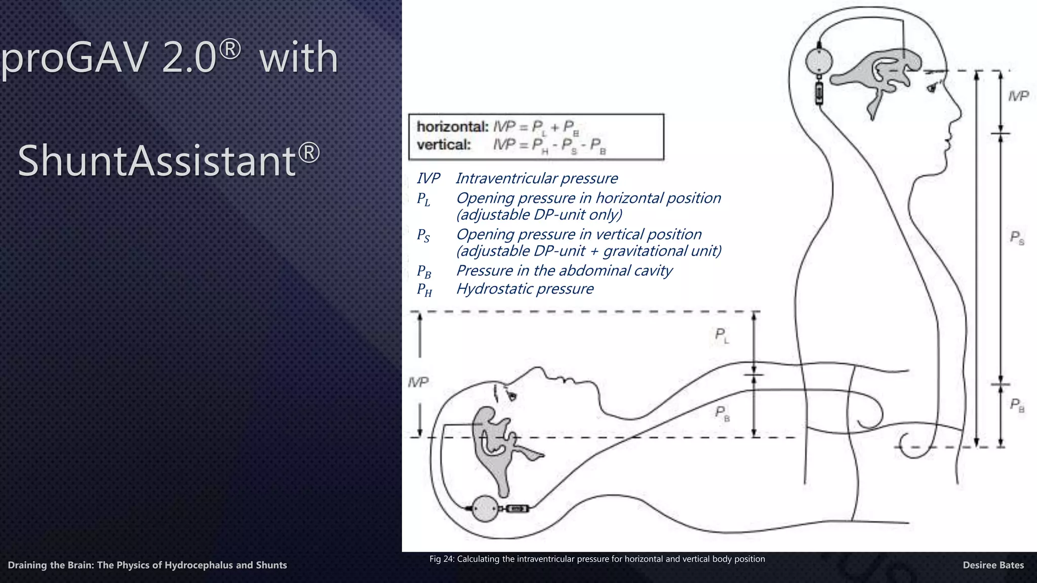 The Physics of Hydrocephalus and Shunts | PPTX