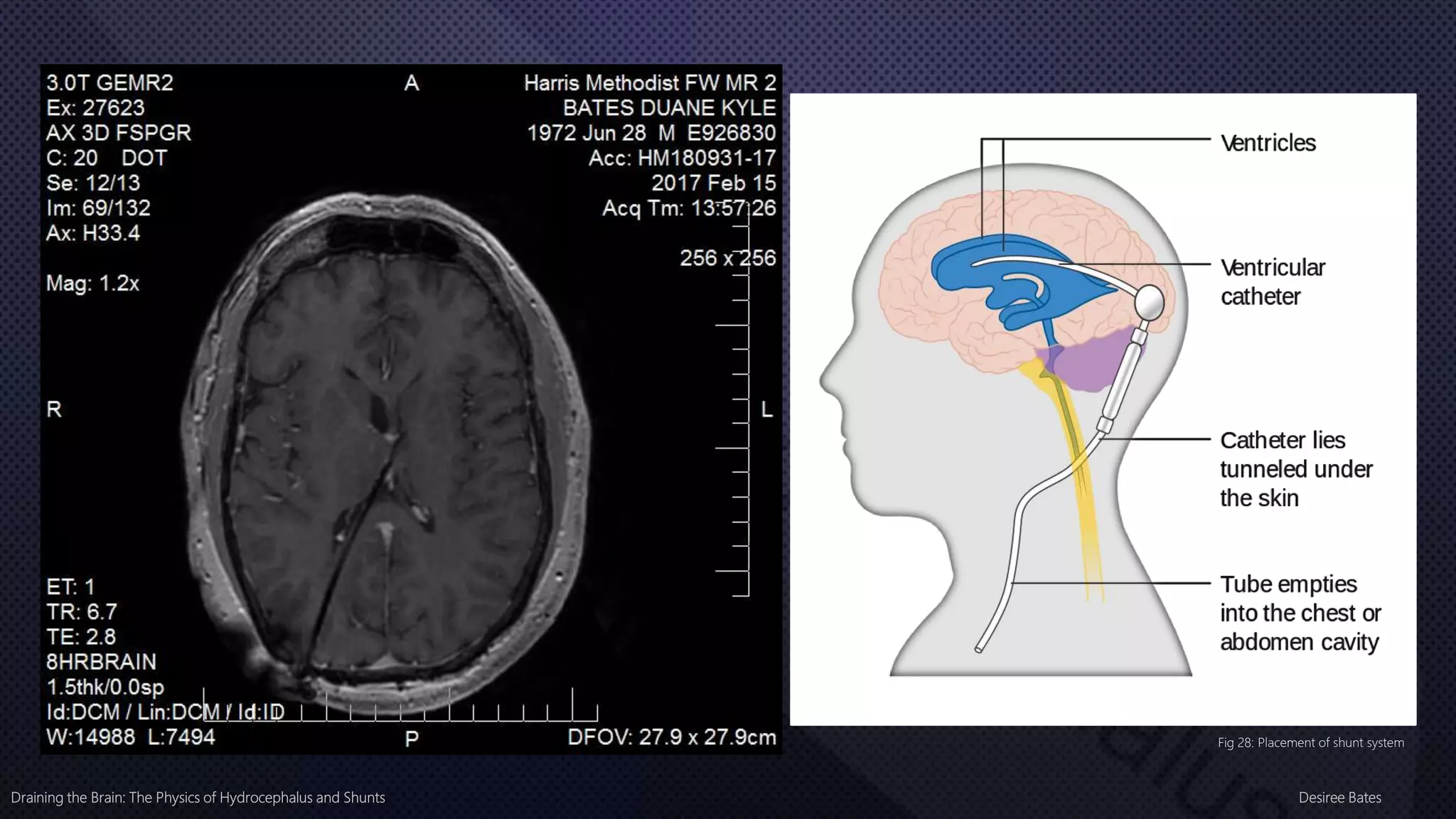 The Physics of Hydrocephalus and Shunts | PPTX