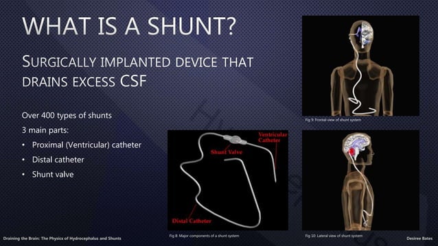 The Physics of Hydrocephalus and Shunts | PPT