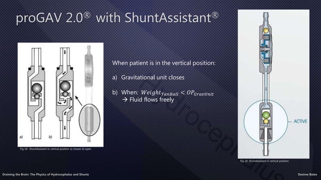 The Physics of Hydrocephalus and Shunts | PPT