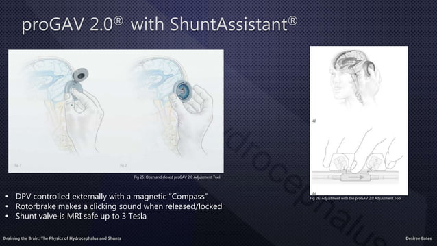 The Physics of Hydrocephalus and Shunts | PPT