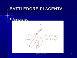 Battledore Placenta