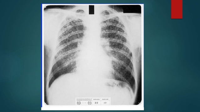 THE PNEUMOCONIOSES - Copy (2).pptx