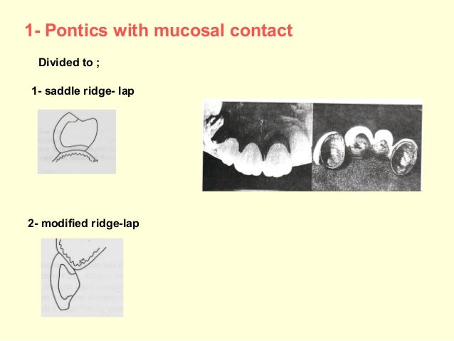 The pontics in_fixed_restorations