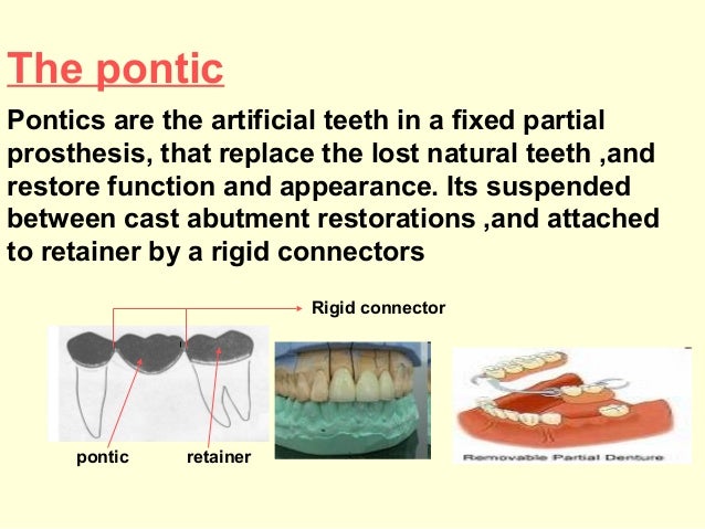 The pontics in_fixed_restorations