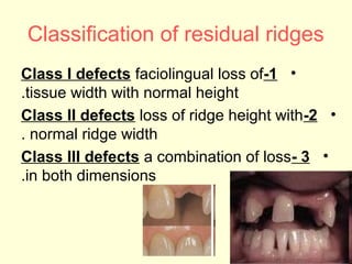 The pontics in_fixed_restorations | PPT