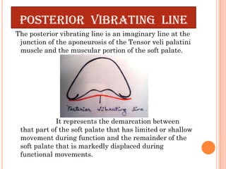 The posterior palatal seal | PPTX